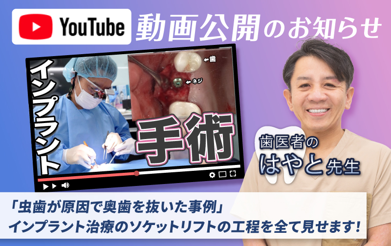 【YouTube動画】「虫歯が原因で奥歯を抜いた事例」インプラント治療のソケットリフトの工程を全て見せます！ | 大井町の歯医者｜インプラント ...